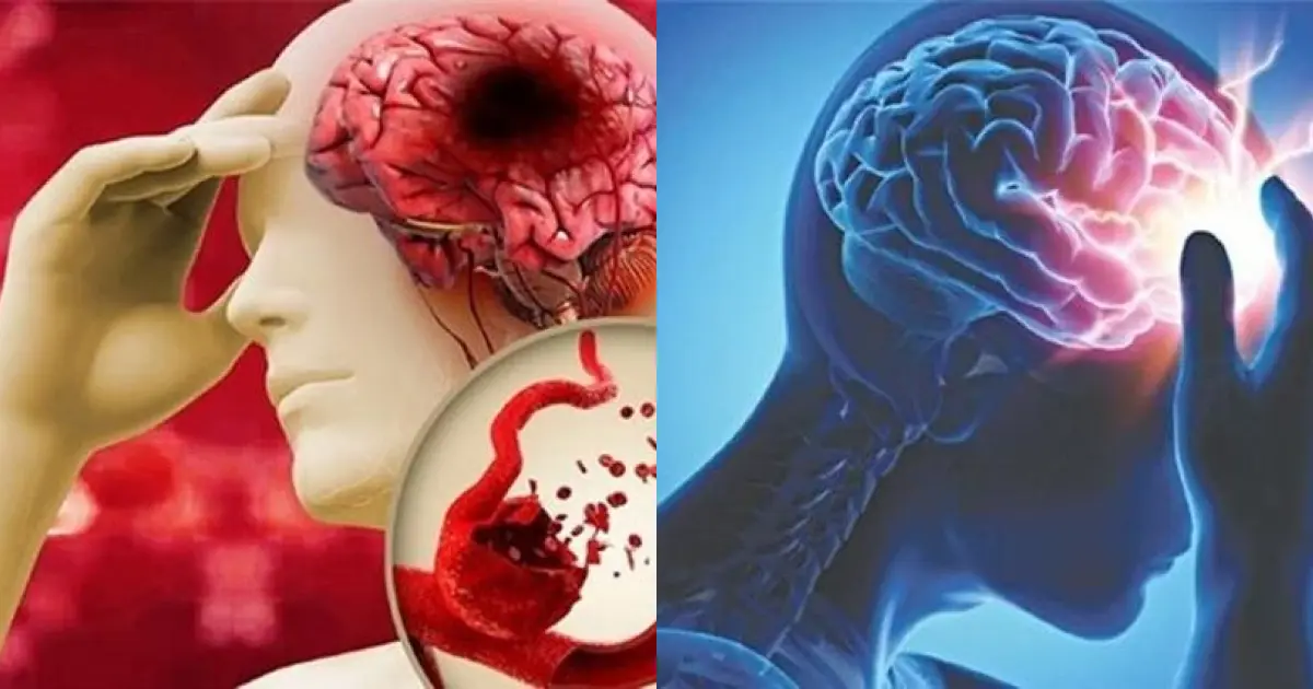 Tiết lộ nhóm máu có nguy cơ bị đột quỵ cao nhất thế giới, đông thứ ba ...